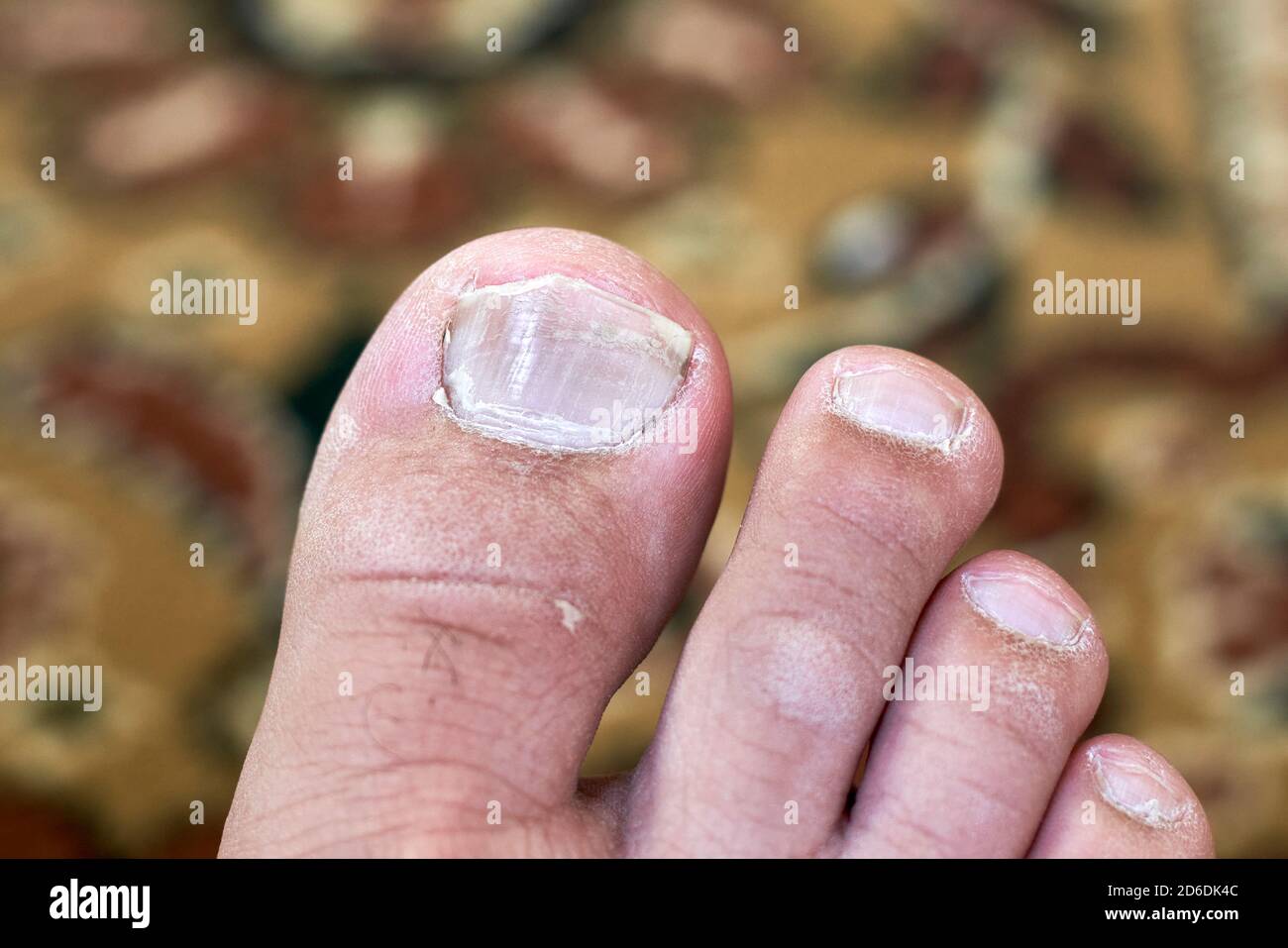 Infection fongique des ongles Banque de photographies et d’images à ...