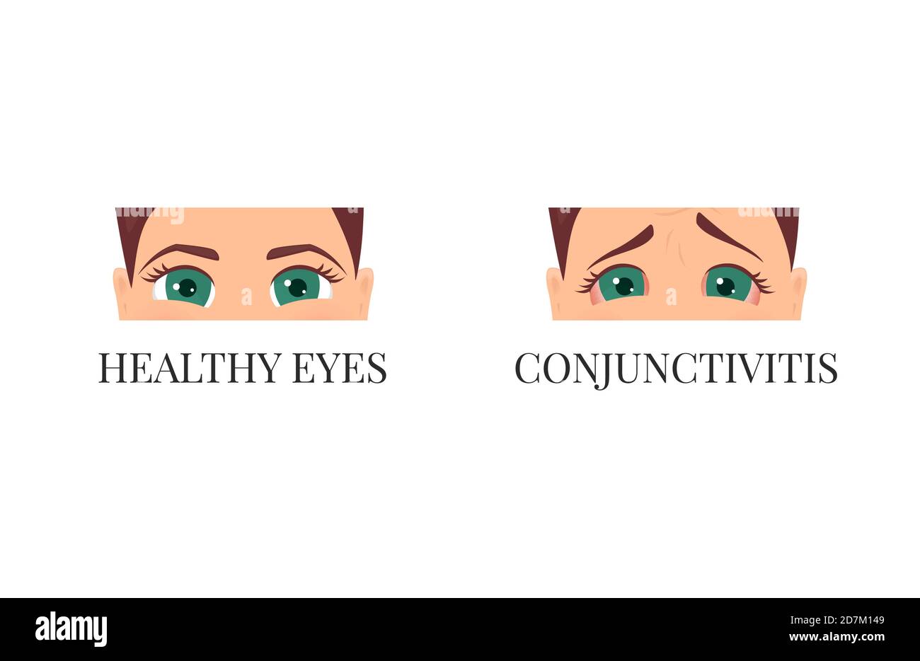 Conjonctivite versus yeux sains, illustration conceptuelle. Femme avec ...