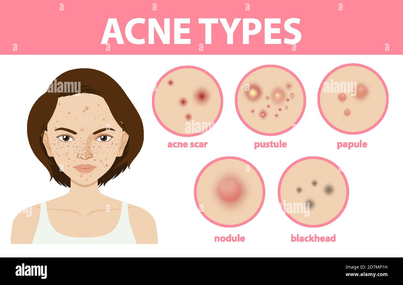 Types d'acné sur la peau ou des boutons illustration Image Vectorielle ...