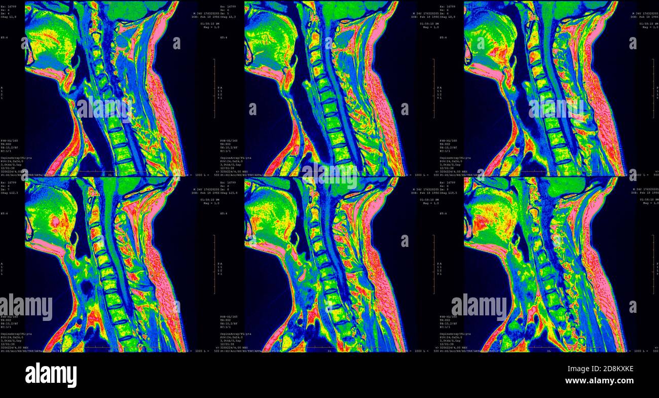 Jeu de 6 acquisitions IRM sagittales de couleur verte du cou zone de ...