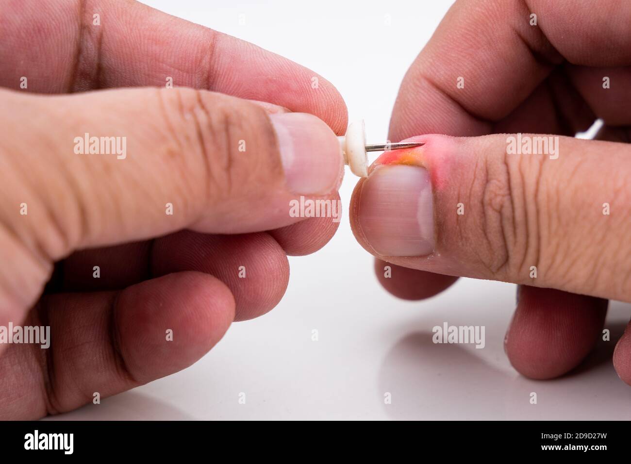 Panaris doigt Banque de photographies et d’images à haute résolution ...