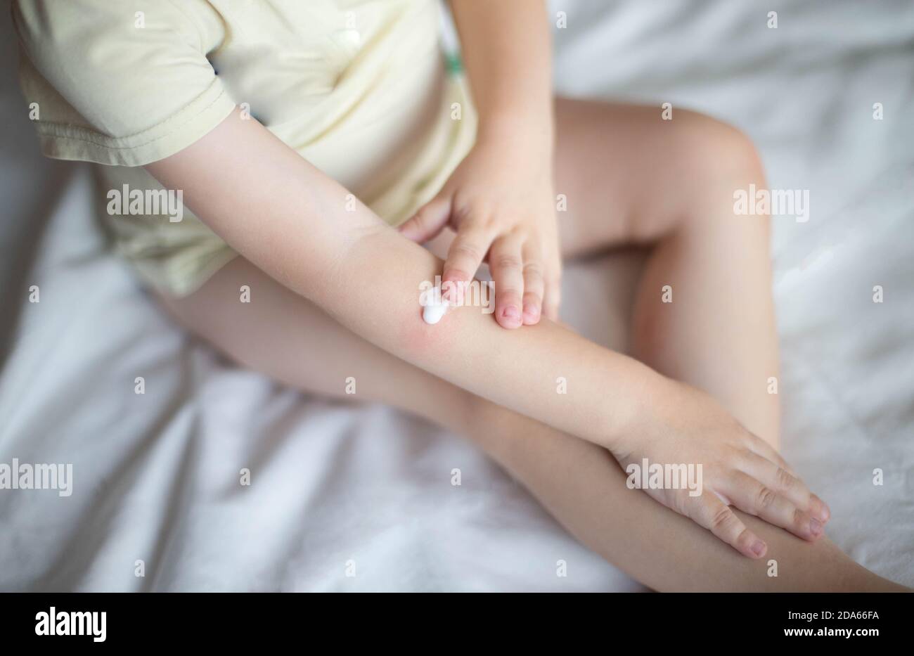 Rougeurs sur les mains Banque de photographies et d’images à haute ...