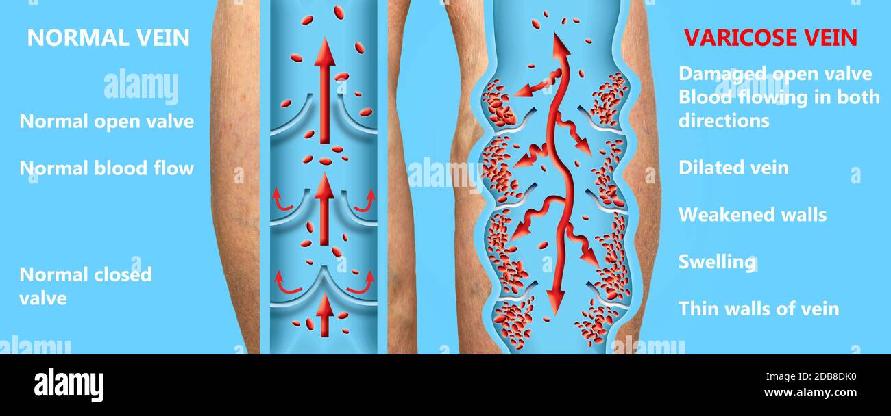 Varices sur les jambes d'une femme senior. La structure de la normale ...