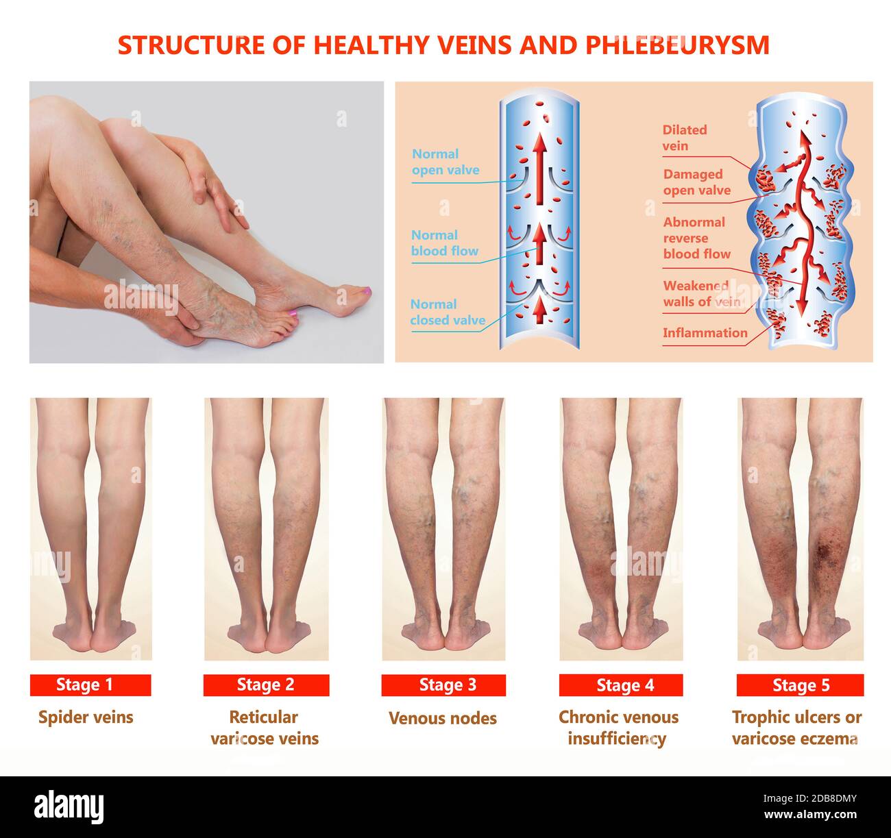 Thrombophlébite. Thrombose veineuse profonde. Varices. Phlebeurysm ...
