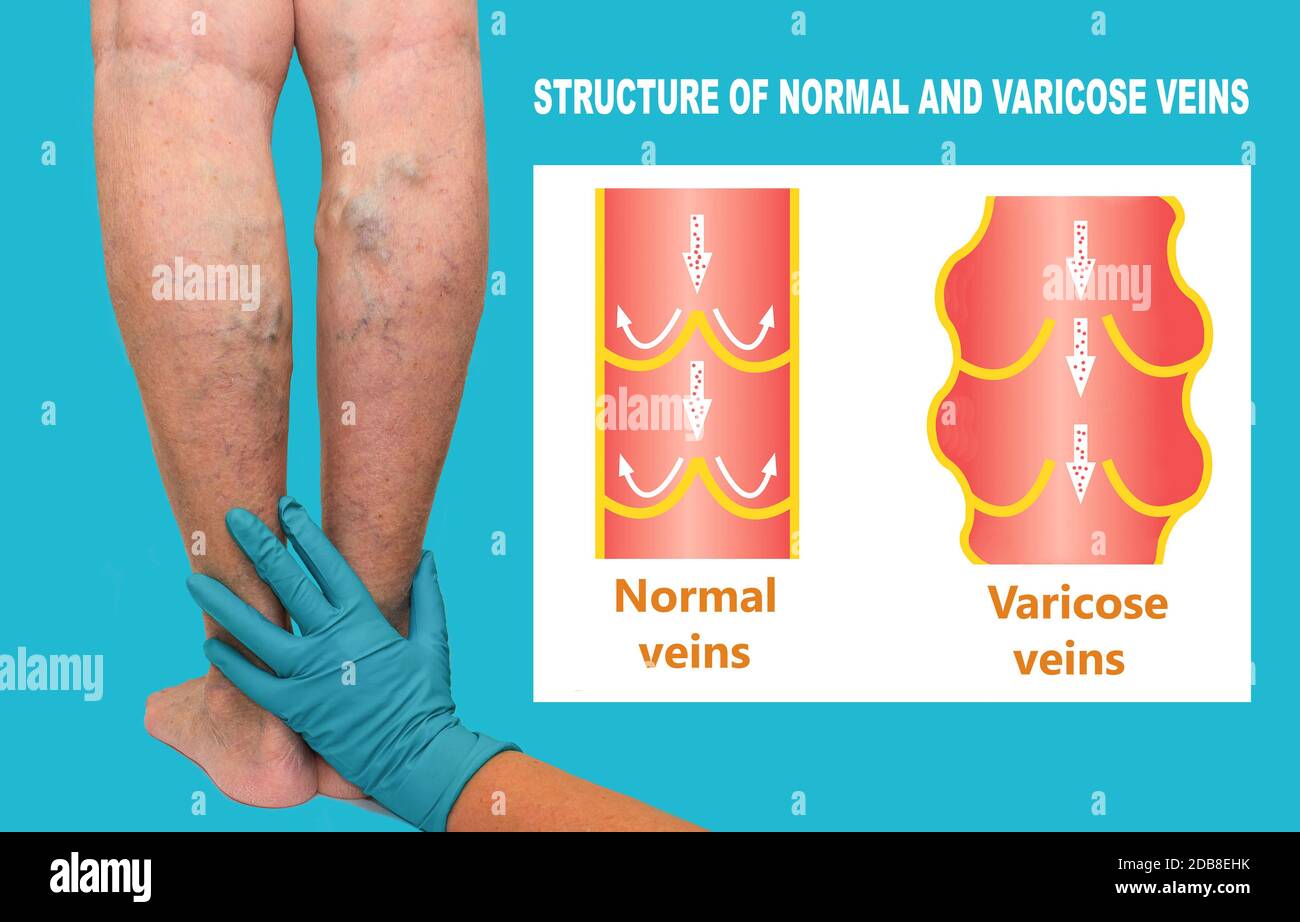 Varices sur les jambes de la femme. La structure des varices et ...