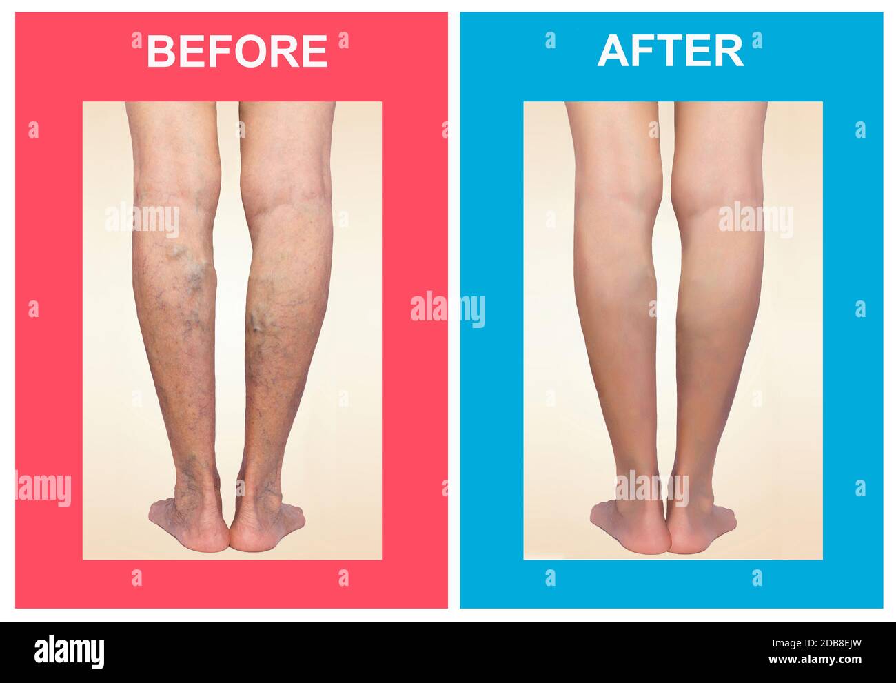 Traitement des varices essentielles avant et après. Varices sur les jambes des femmes cadres ...