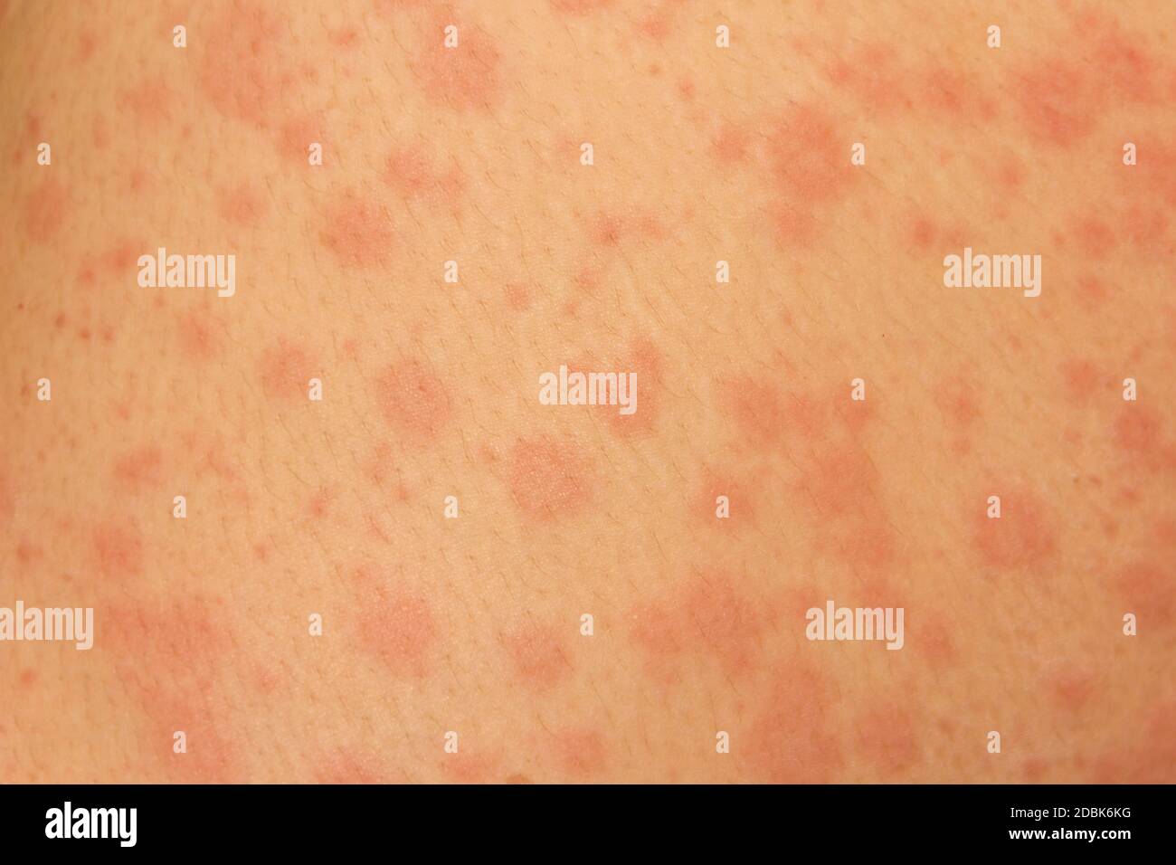 Lésions prurigineuses Banque de photographies et d’images à haute ...