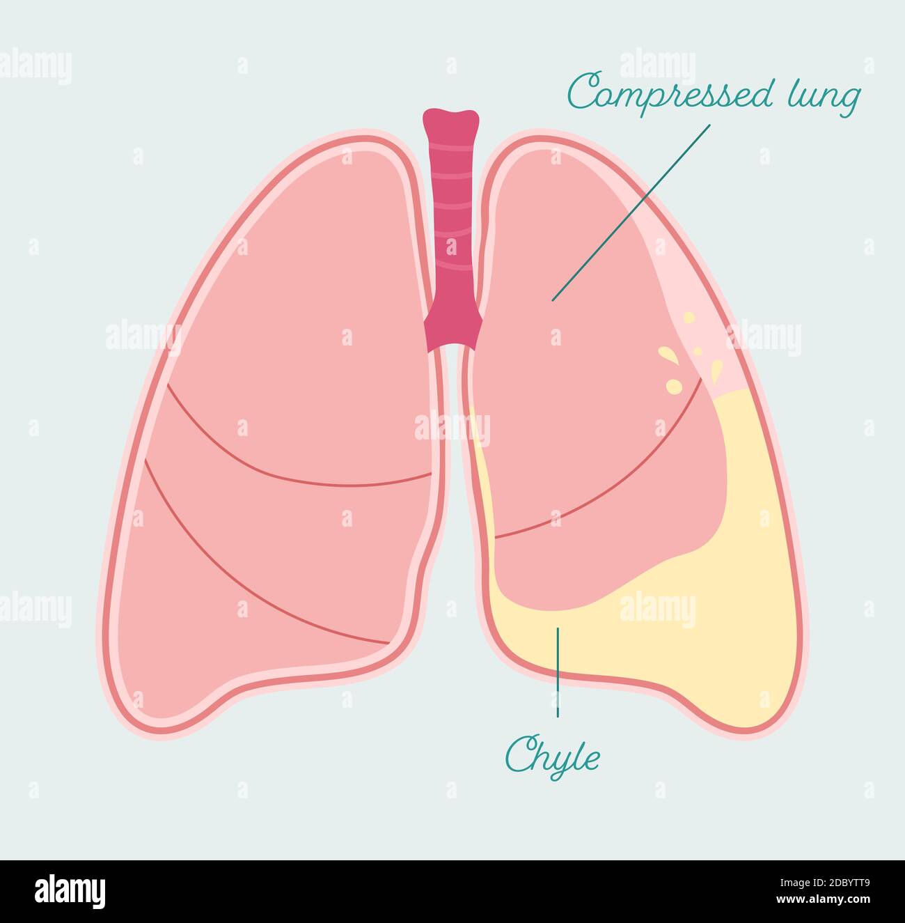 Chylothorax - Schéma anatomique dessiné à la main. Rassemblement de ...