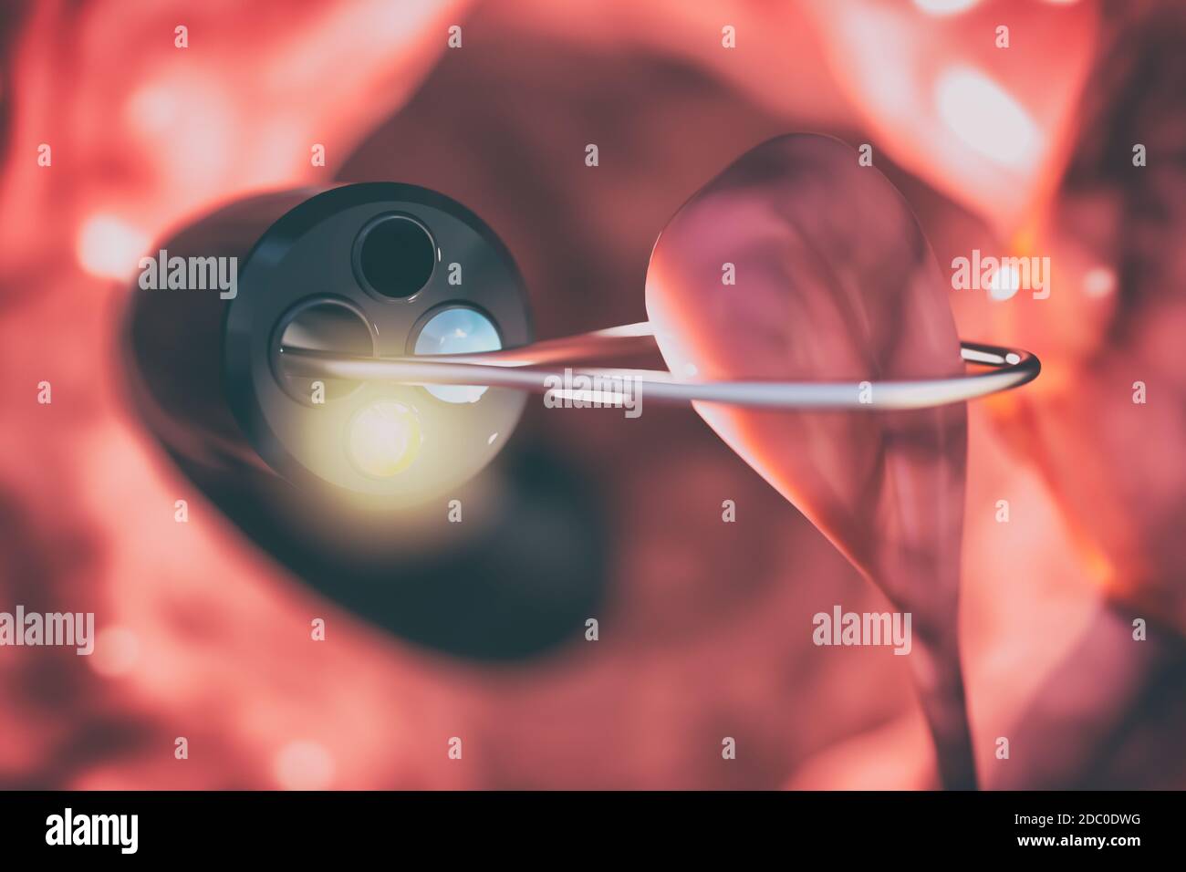 Retrait du polype de la paroi intestinale à l'aide d'un colonoscope ...