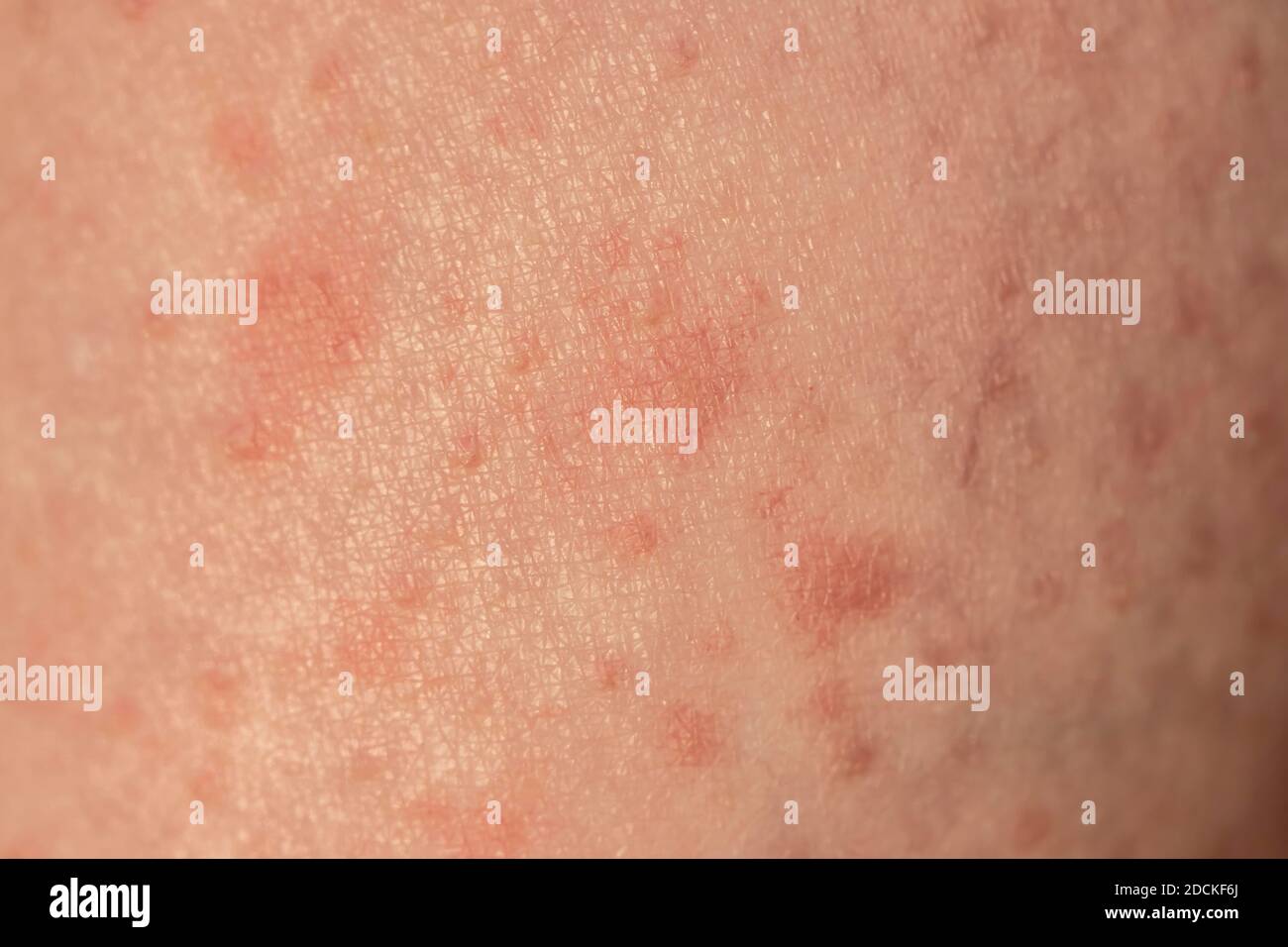 Peau avec taches rouillées, éruption cutanée, allergie Photo Stock - Alamy