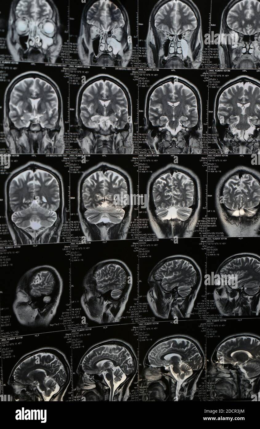 Scanner du cerveau Banque de photographies et d’images à haute ...