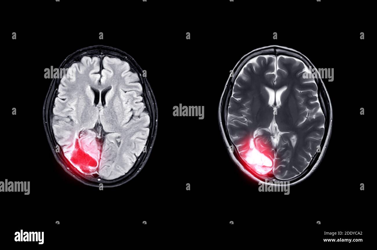 Flair mri Banque de photographies et d’images à haute résolution - Alamy