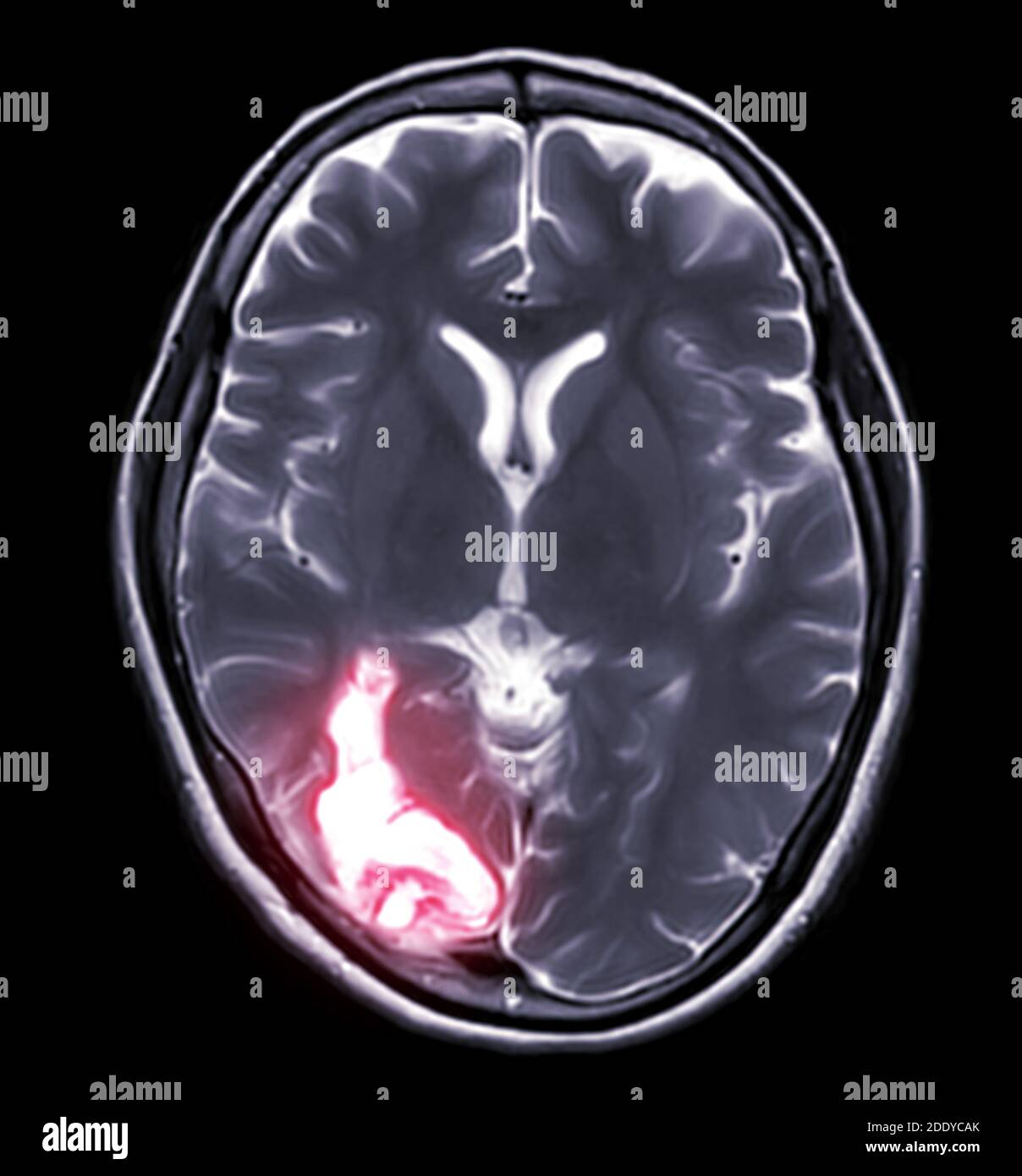 Vue en T2 axiale du cerveau par IRM montrant la maladie d ...