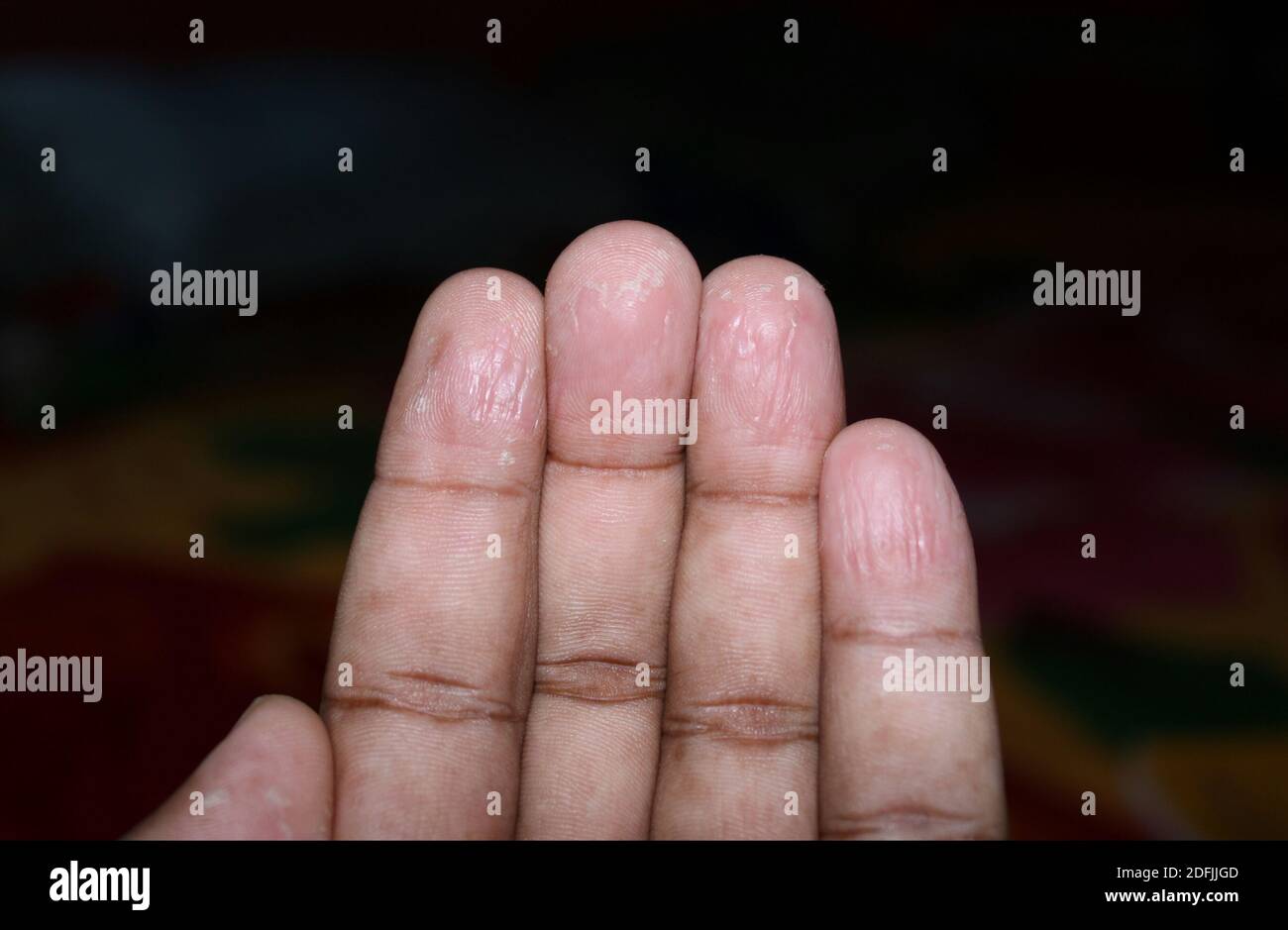 Maladies de la peau psoriasis sur la paume Photo Stock - Alamy