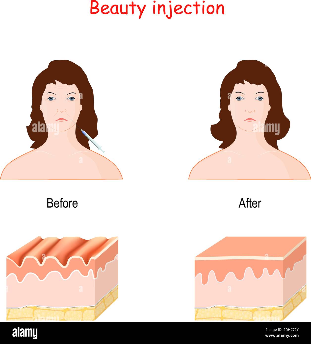 injection de beauté. soutireuse cutanée. injection d'acide hyaluronique ...