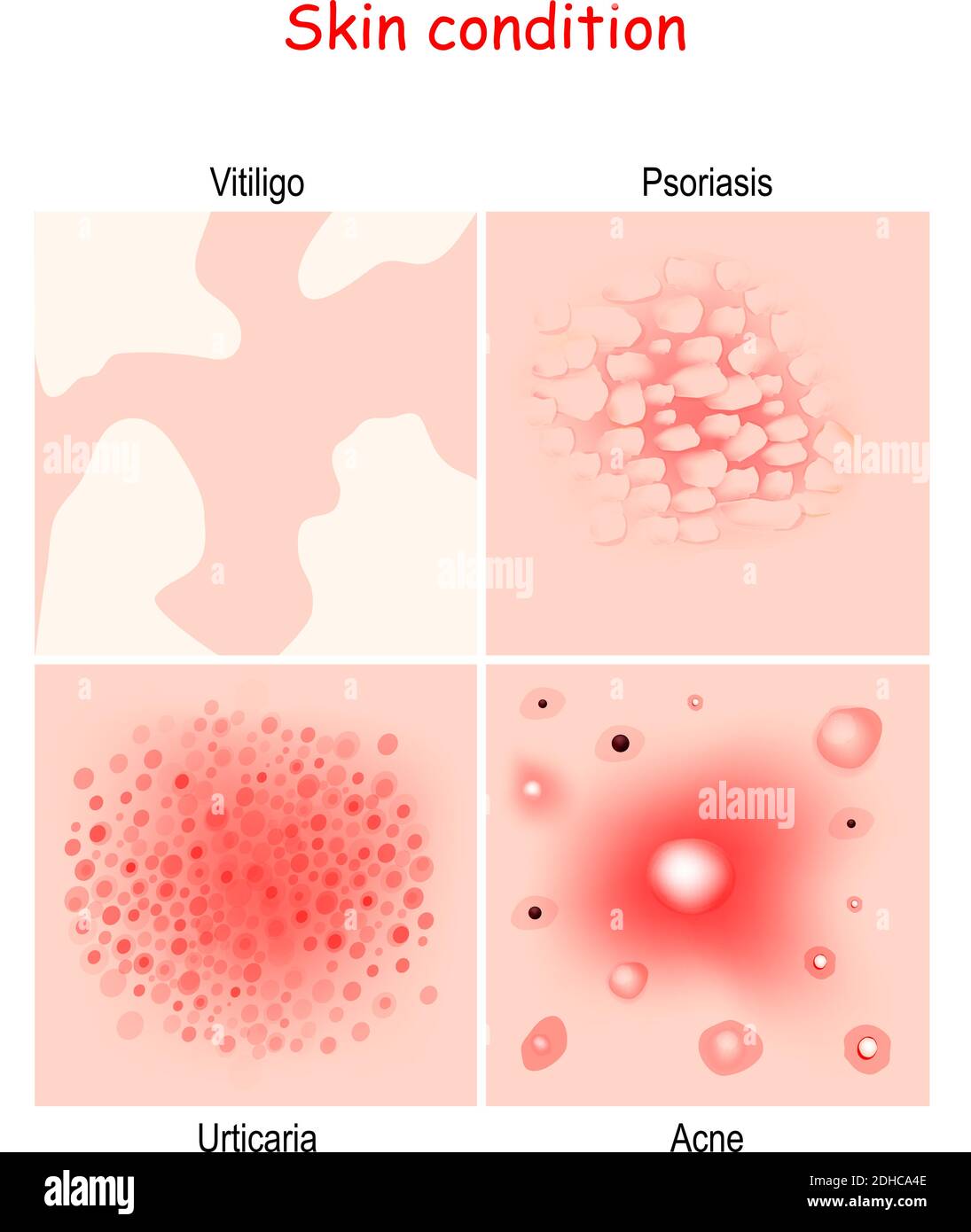 État de la peau et maladies. Gros plan de l'acné, urticaire, psoriasis ...