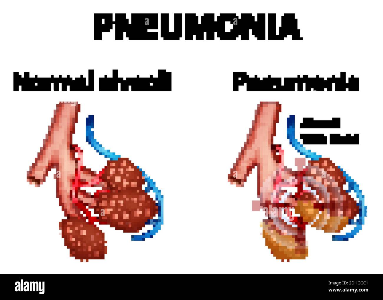 Anatomie humaine montrant une illustration de la pneumonie Image ...