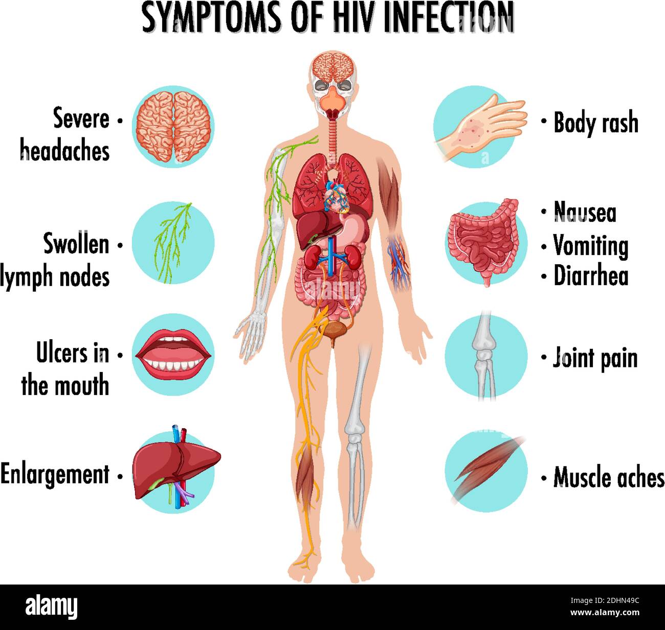 Illustration de l'infographie sur les symptômes de l'infection à VIH ...