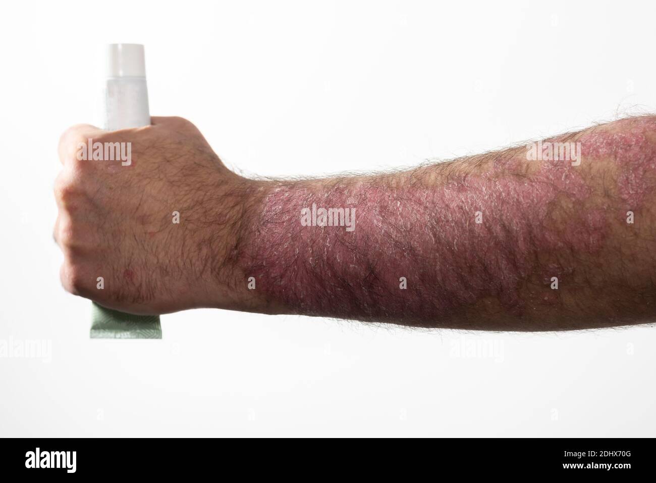 Les maladies de la peau Banque de photographies et d’images à haute ...