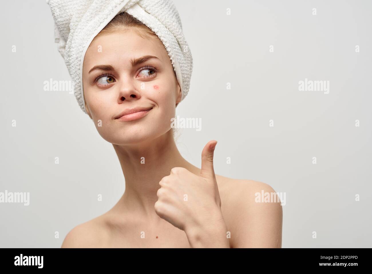 Skin rash eczema on hands Banque de photographies et d’images à haute ...