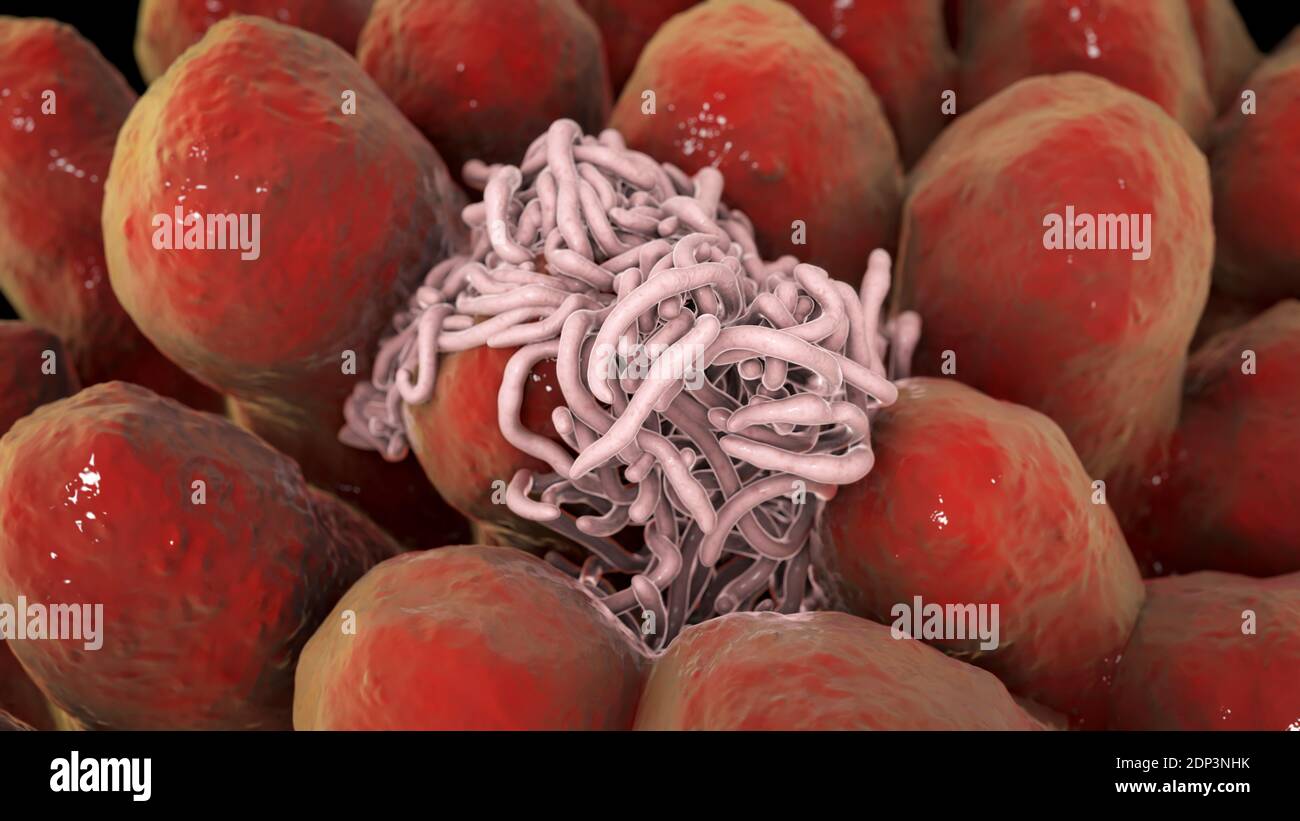 Vers ronds dans l'intestin humain, illustration informatique. Les vers ...