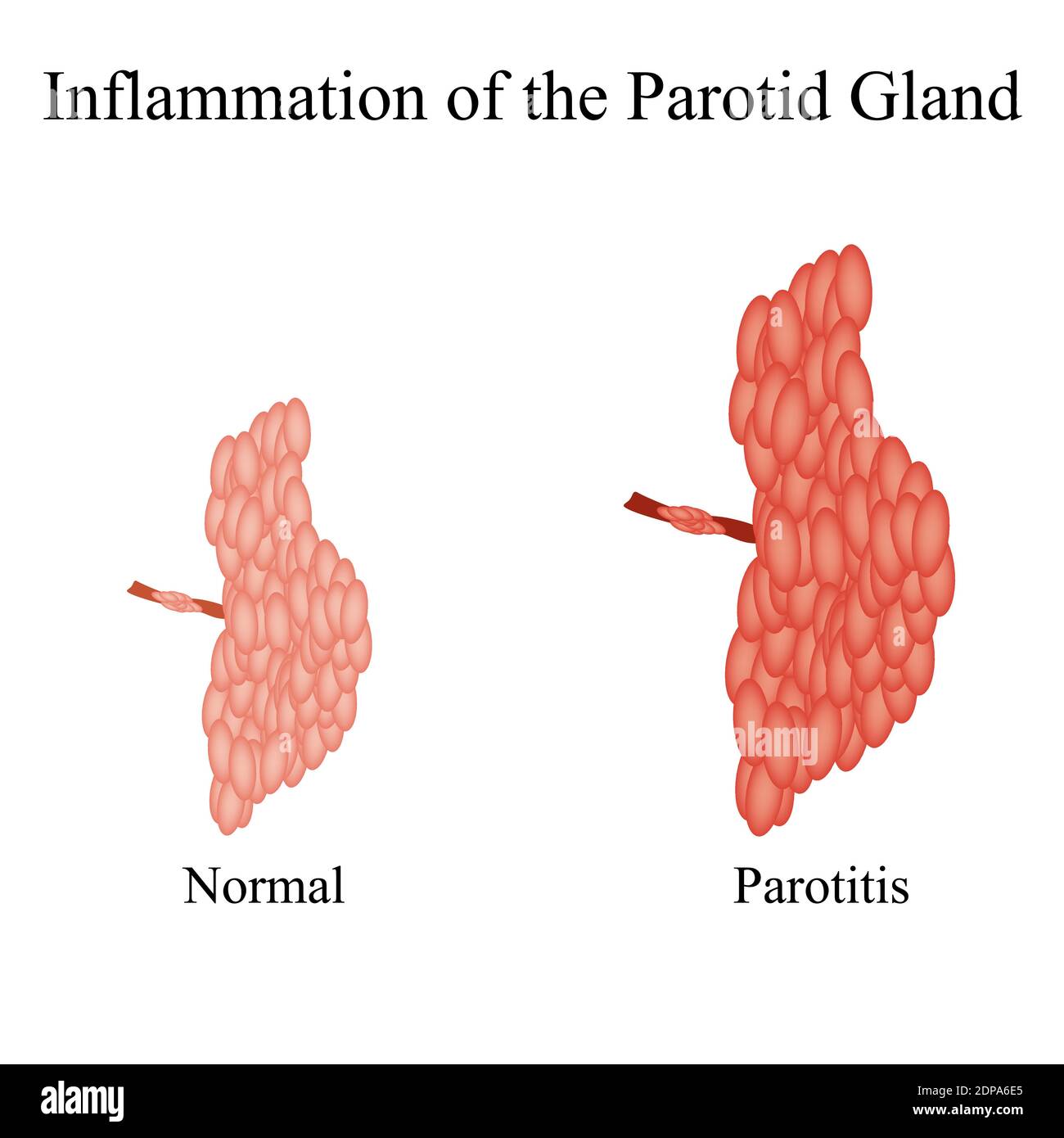 Inflammation de la glande parotide.structure de la glande paratide ...