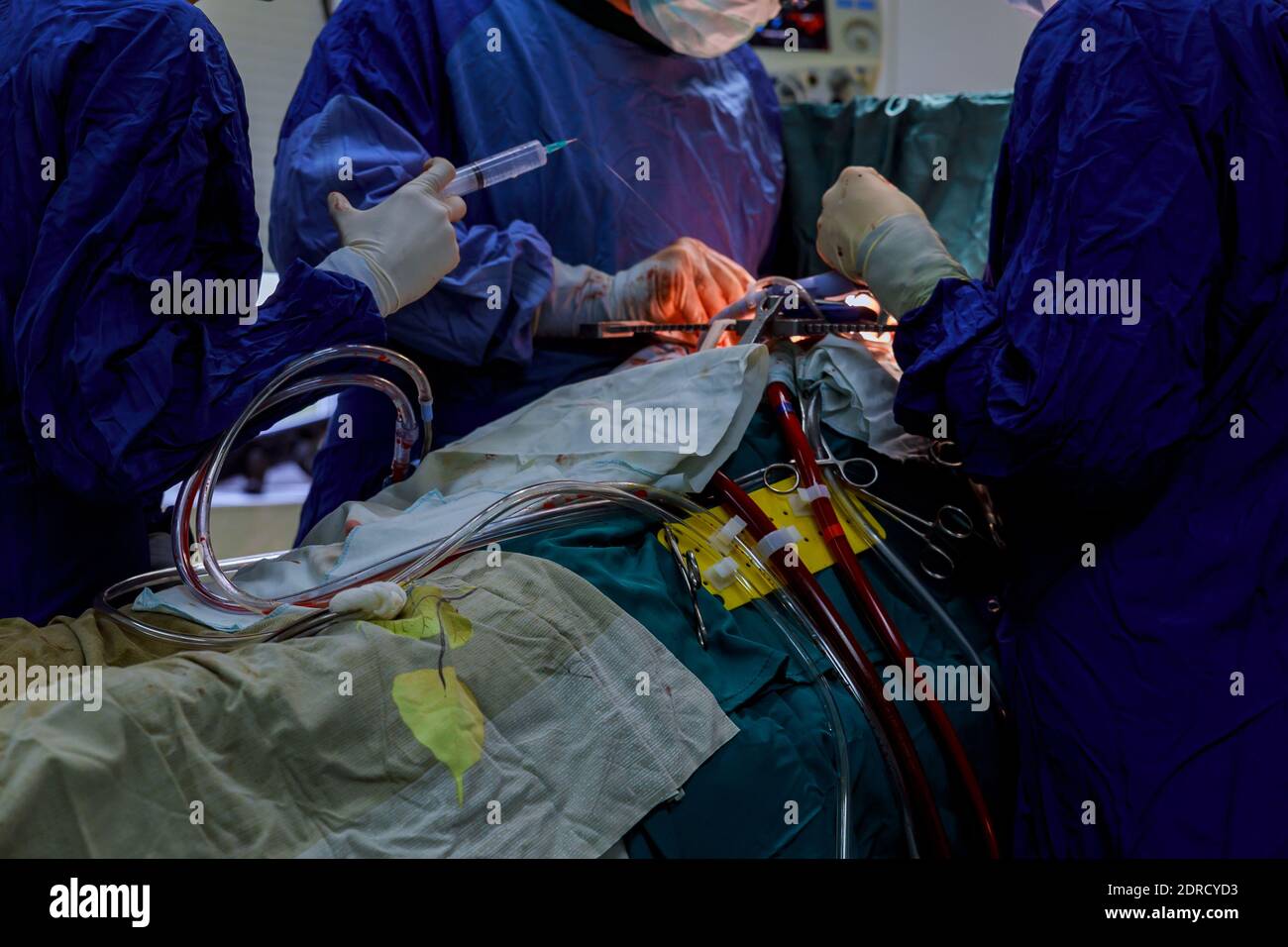 Pontage Coronarien Banque d'image et photos - Alamy