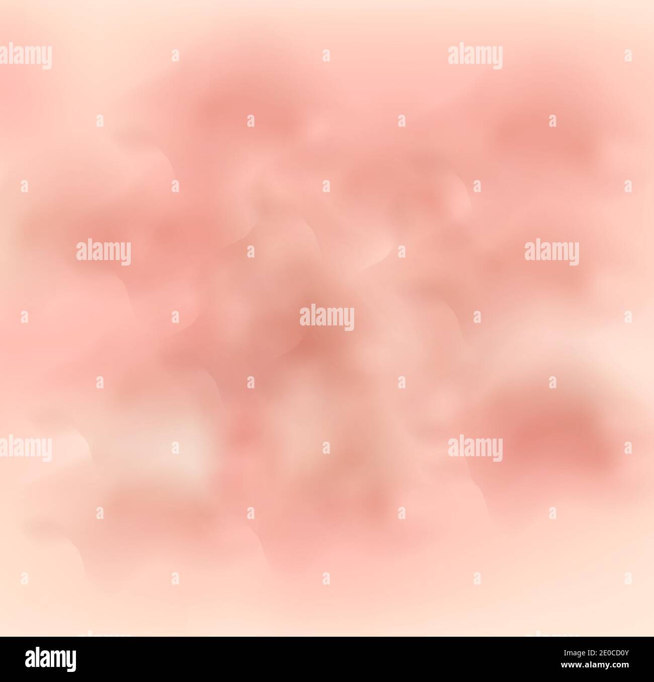 Inflammation de la peau, erysipelas. Psoriasis, séborrhée, dermatite ...