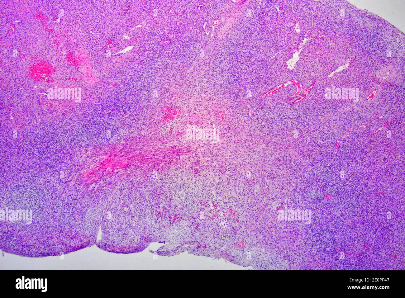 Ovaire sénile humain avec cellules stroma en forme de fuseau. X25 à 10 ...