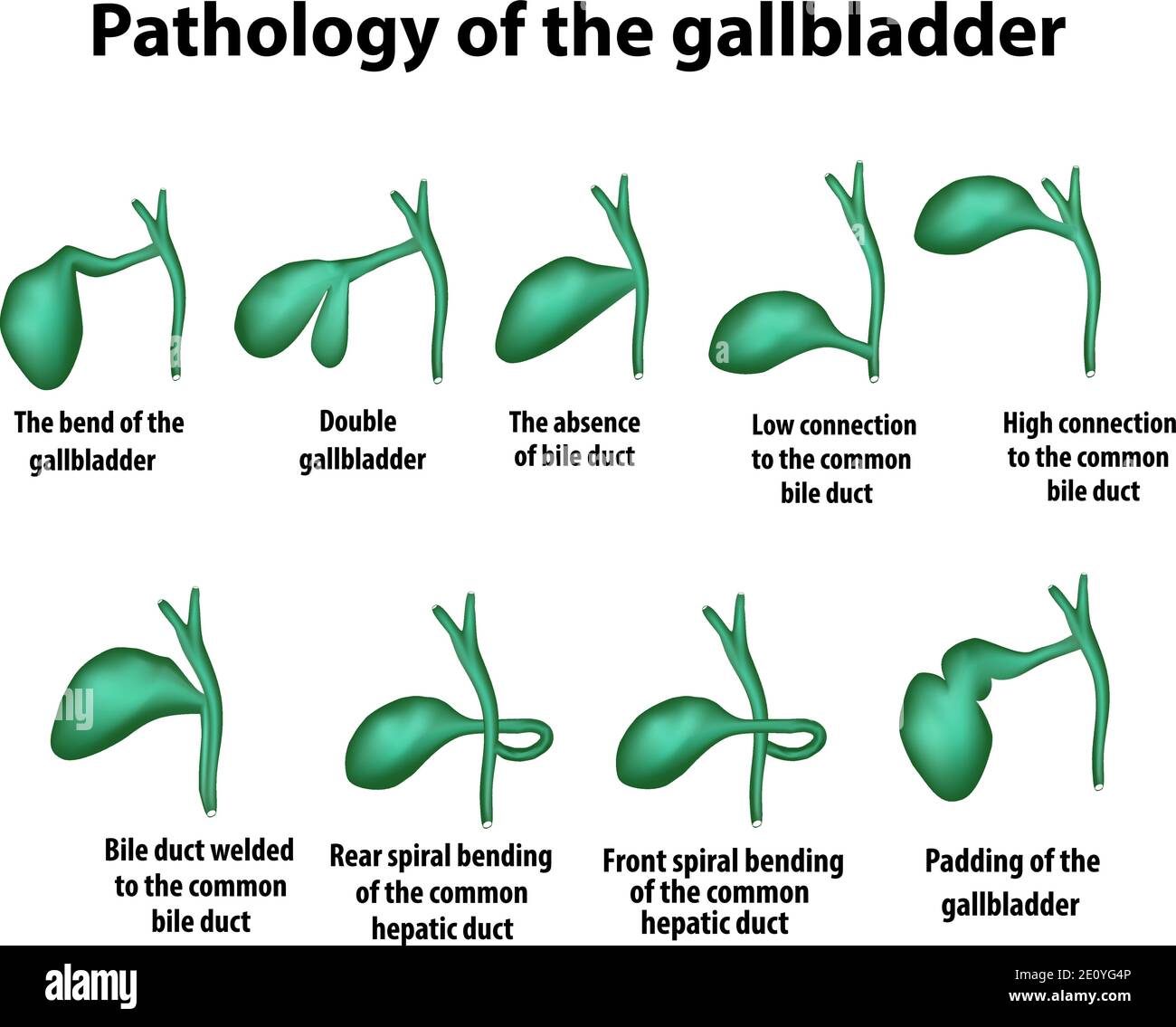 Pathologie de la vésicule biliaire. Le pli de la vésicule biliaire ...