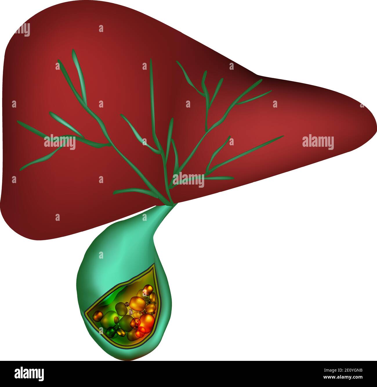 Calculs biliaires. Cholélithiase. Cholécystite. Inflammation de la ...