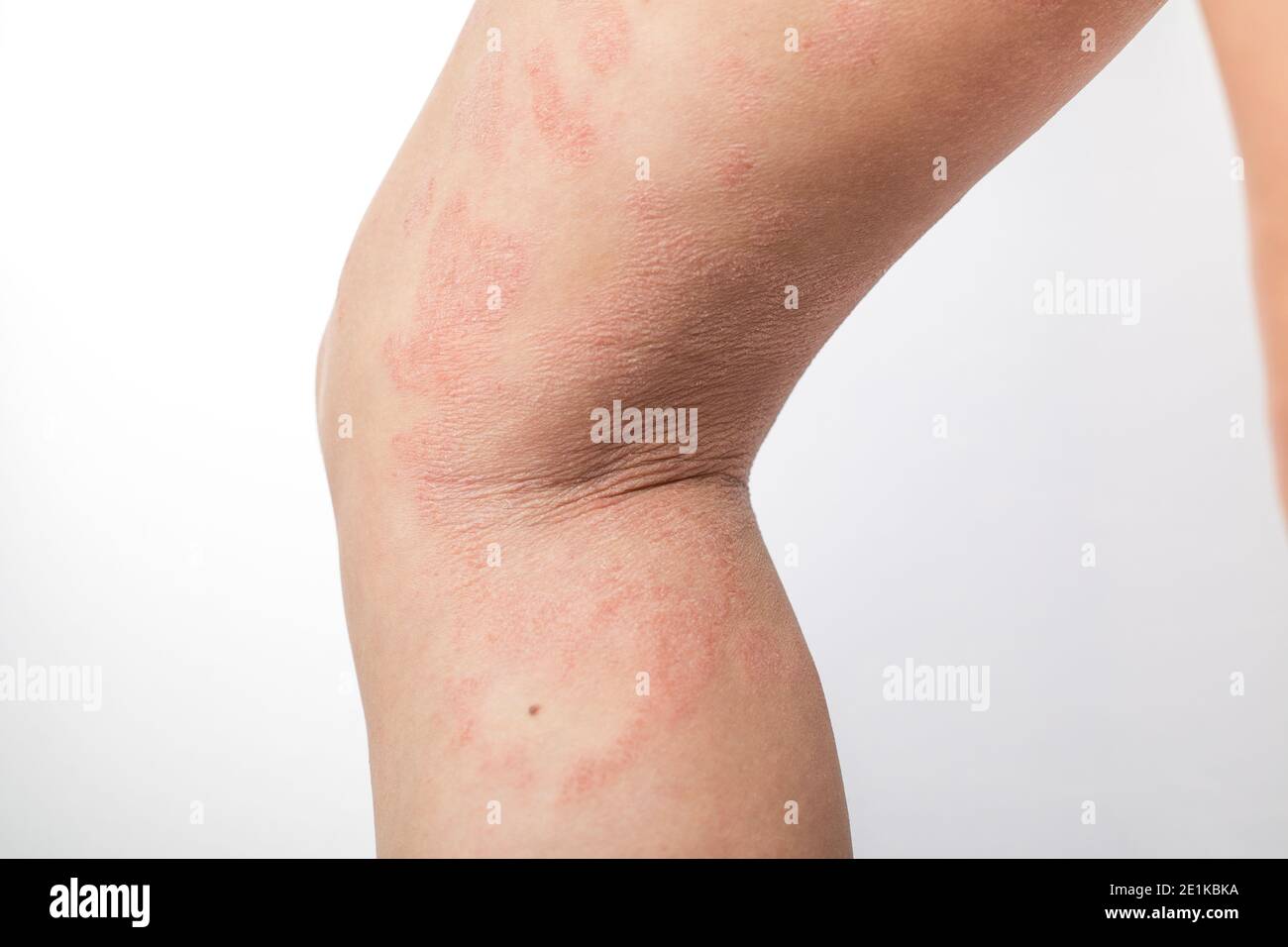 L'eczéma atopique sévère sur les jambes d'un enfant est une maladie ...