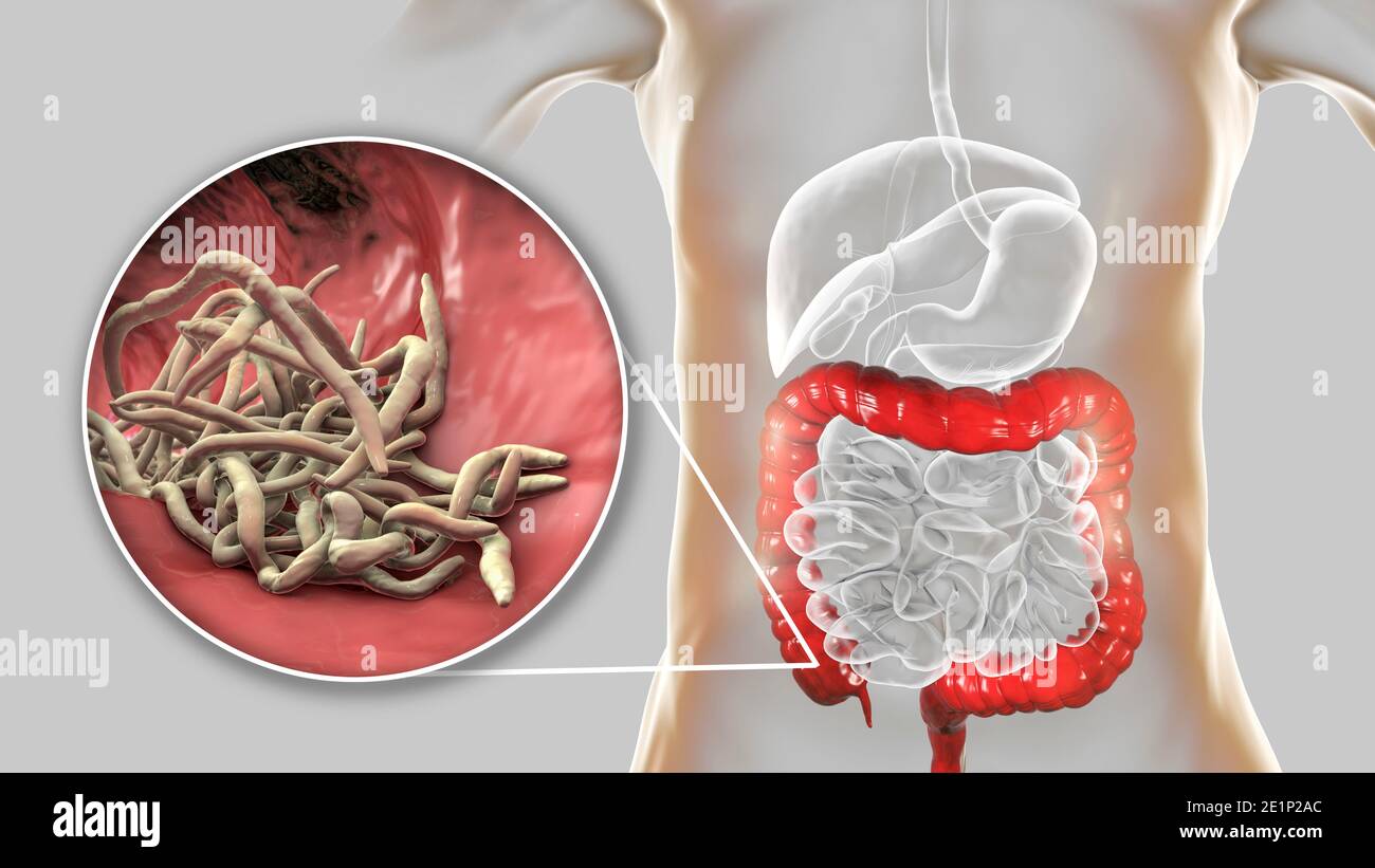Vers intestinaux humain ronds Banque de photographies et d’images à ...