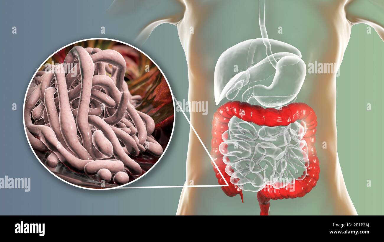 Ascaris lumbricoides Banque de photographies et d’images à haute ...