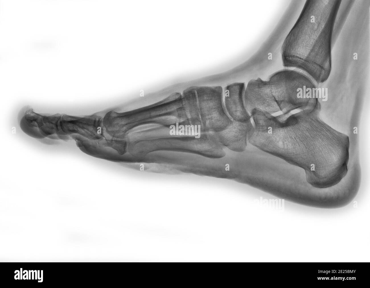 Radiologie pied normale Banque de photographies et d’images à haute ...