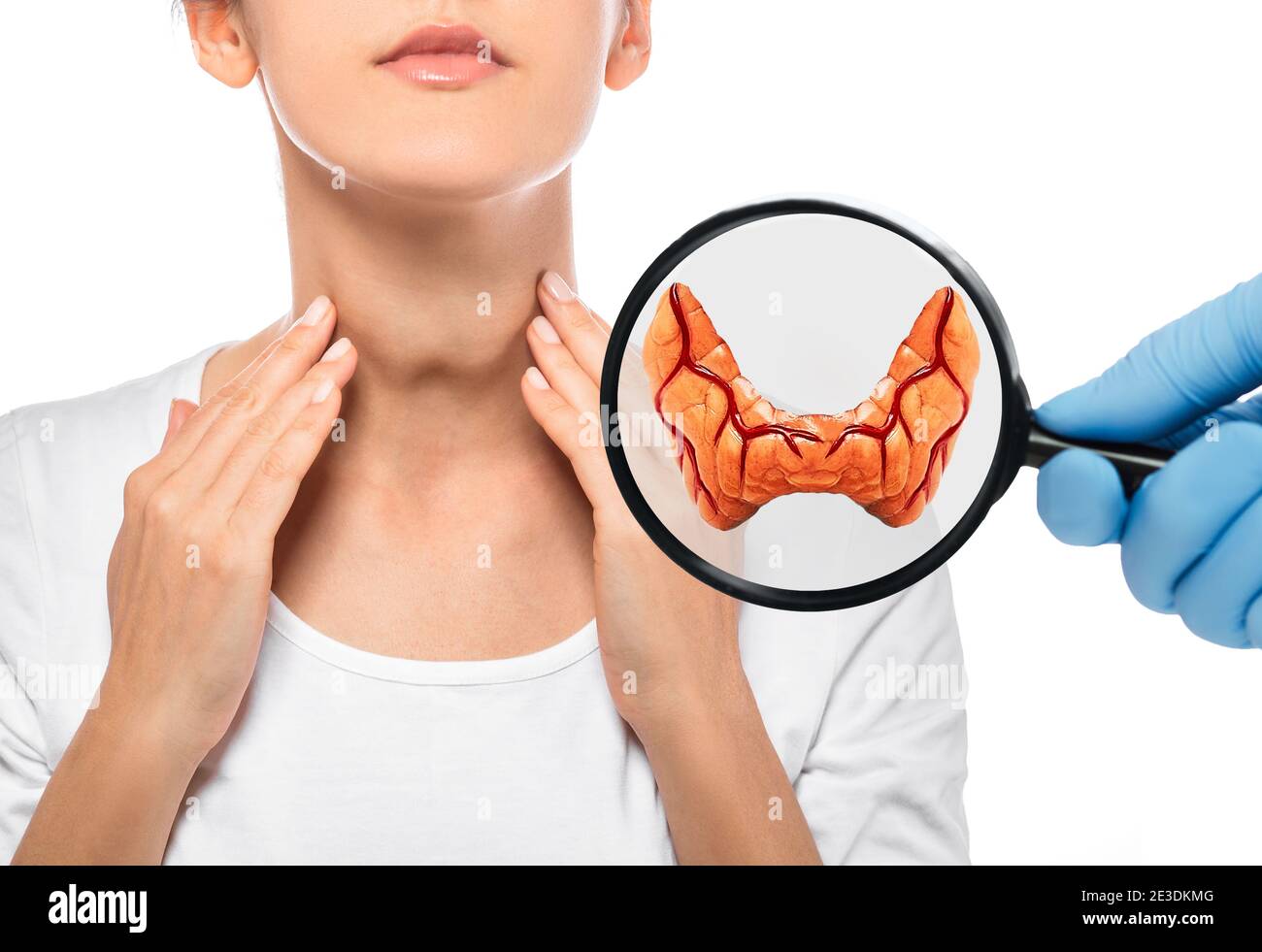 Goitre Thyroïde Banque d'image et photos - Alamy