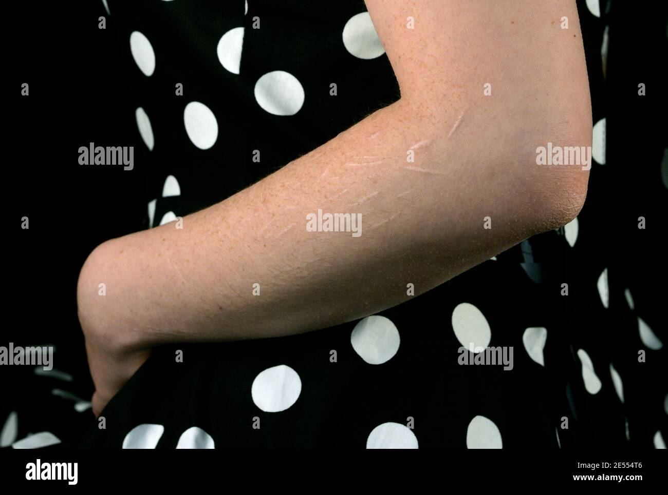 Self Harm Arm Banque d'image et photos - Alamy