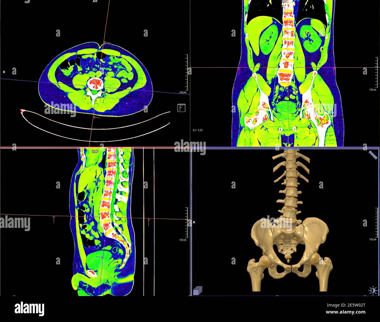 Collection d'images de rendu 3D CT du rachis lombaire ou du rachis L-S AP , coronal , vue ...