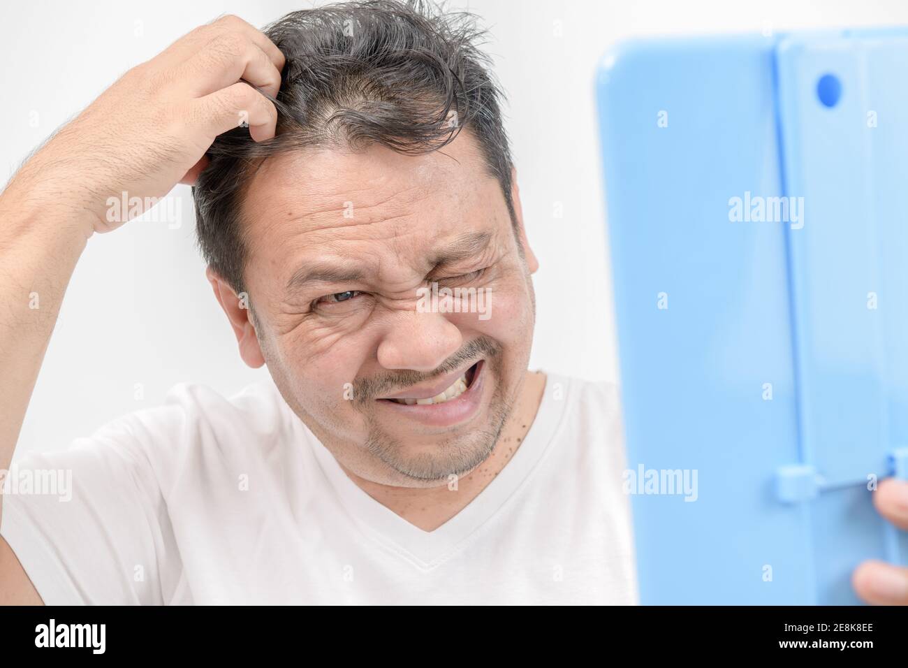 Skin rash eczema on hands Banque de photographies et d’images à haute ...