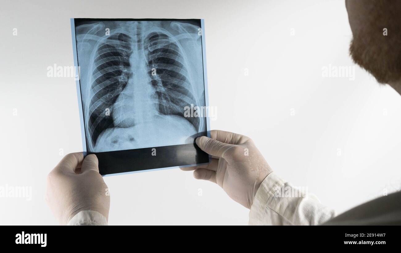 Radiographie des poumons humains sur fond d'abel, maladie respiratoire ...