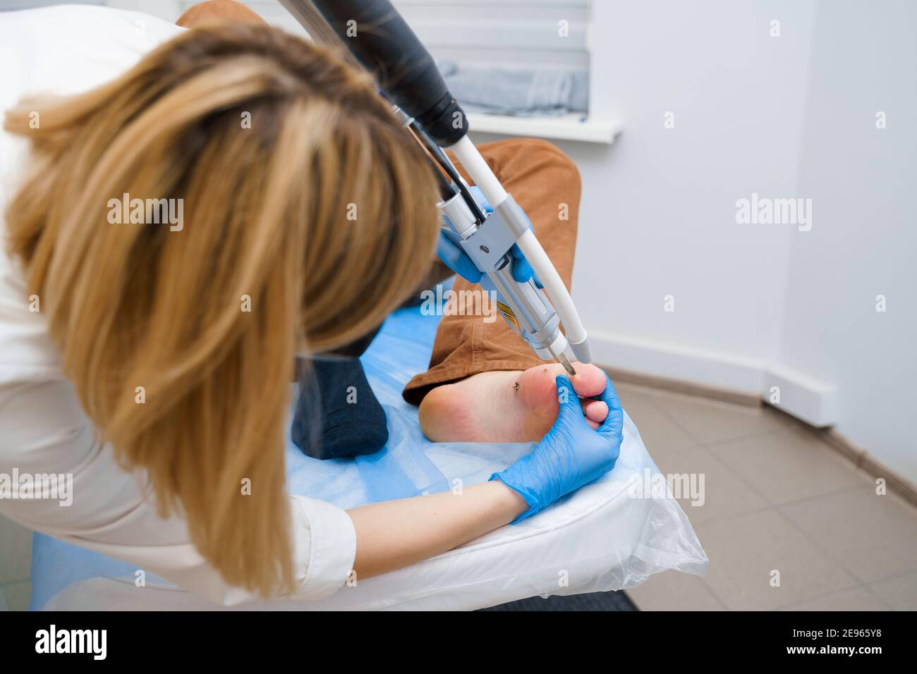 Enlèvement au laser des verrues sur le pied. Chirurgie dermatologique ...