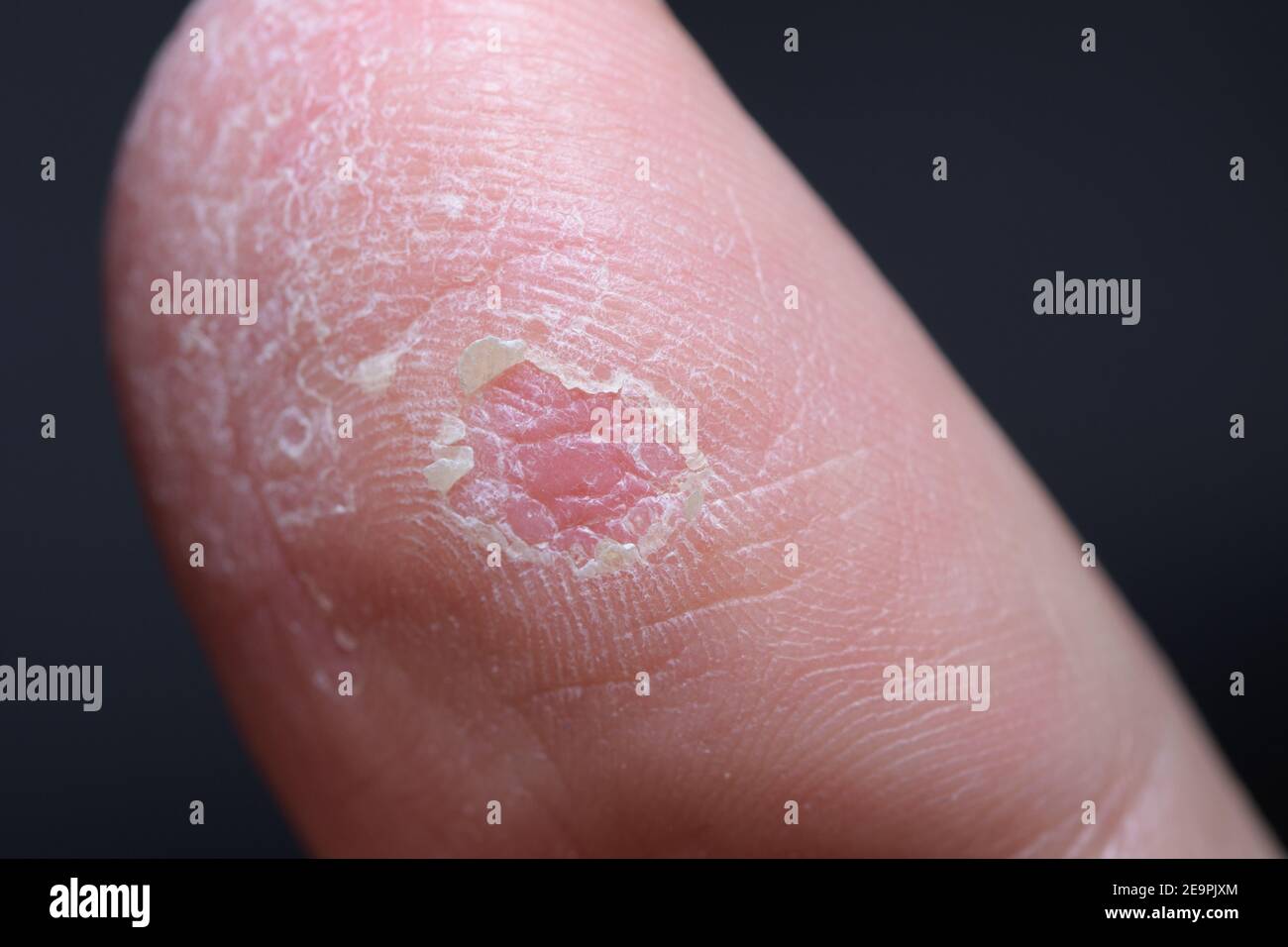 Maladie dermatologique Banque de photographies et d’images à haute ...