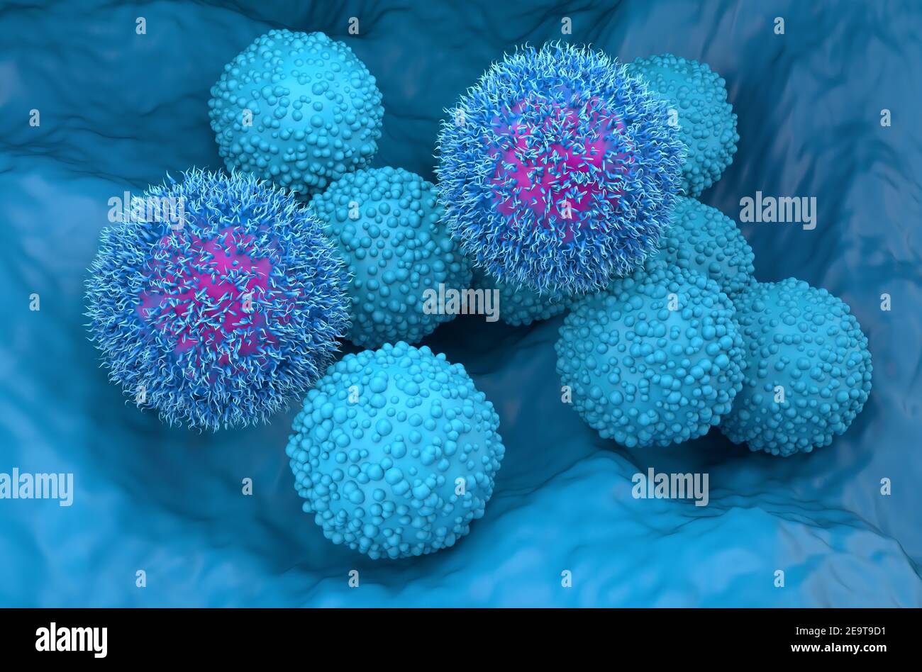 Cancer du pancréas cellules tumorales 3d illustration vue isométrique ...