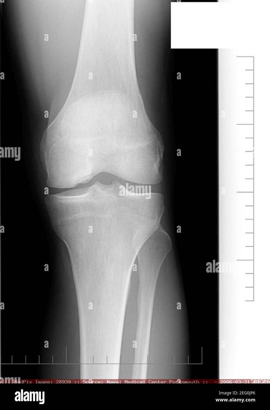 Condyle médial Banque de photographies et d’images à haute résolution ...