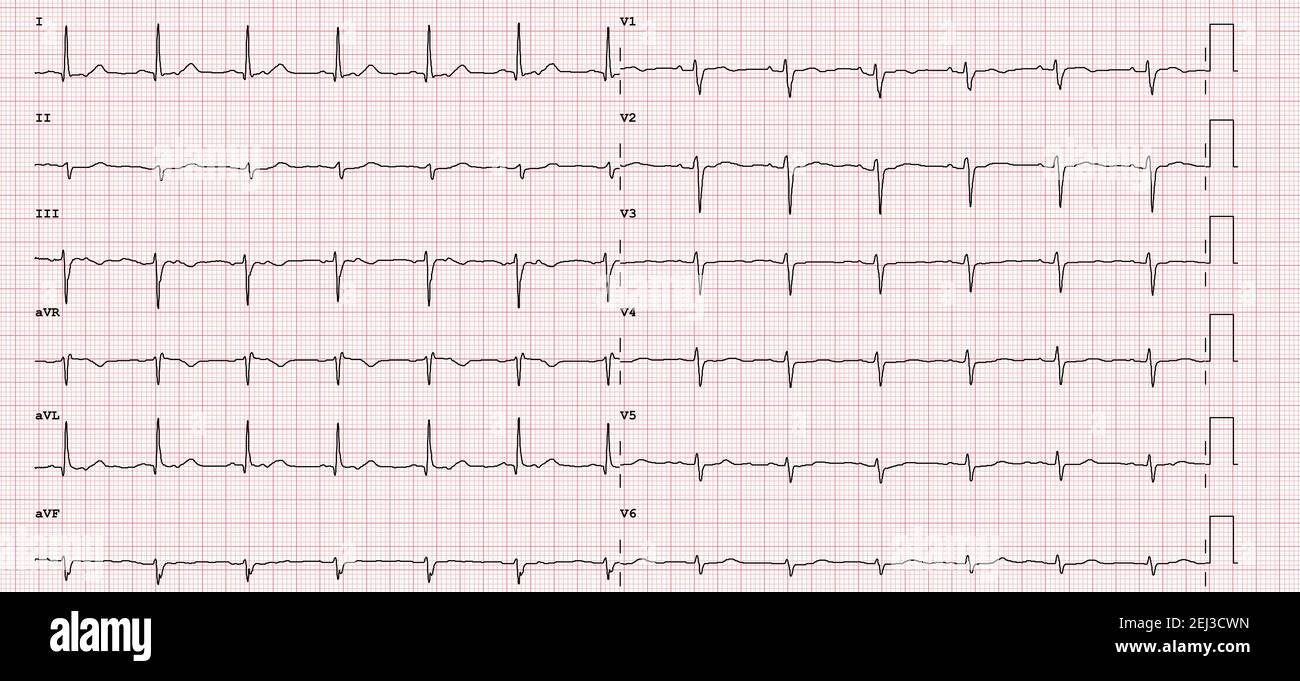 Exemple ECG d'un rythme sinusal normal à 12 dérivations Photo Stock - Alamy