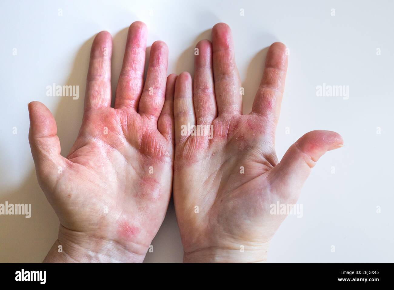 Rougeurs sur les mains Banque de photographies et d’images à haute ...