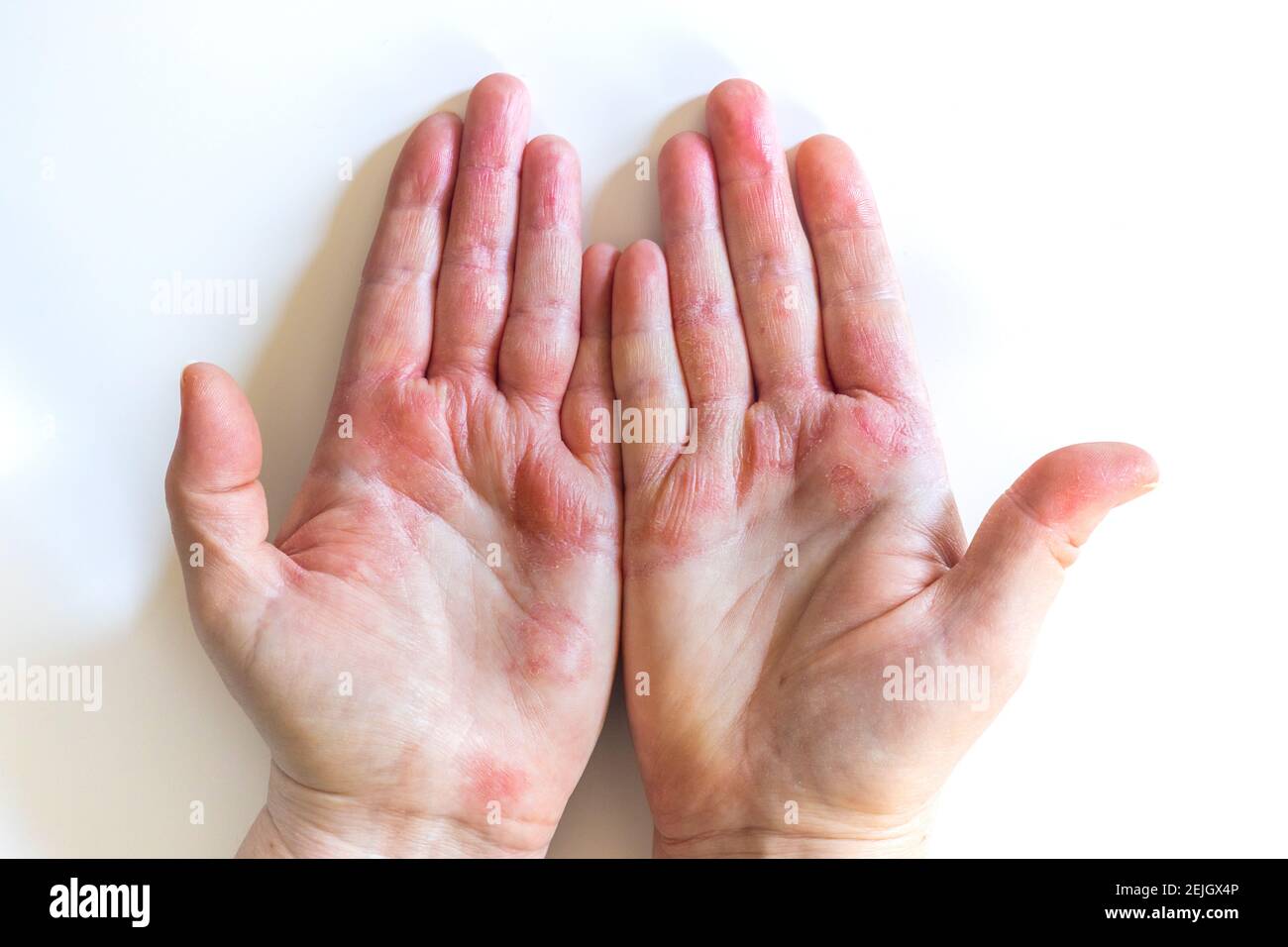 Skin rash eczema on hands Banque de photographies et d’images à haute ...