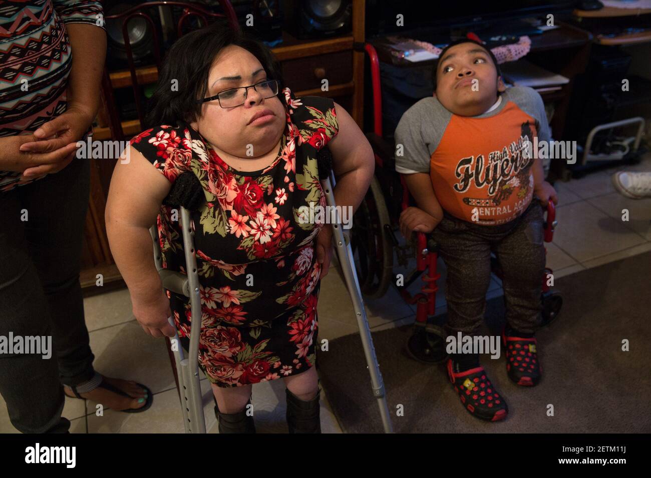 Morquio syndrome Banque de photographies et d’images à haute résolution ...