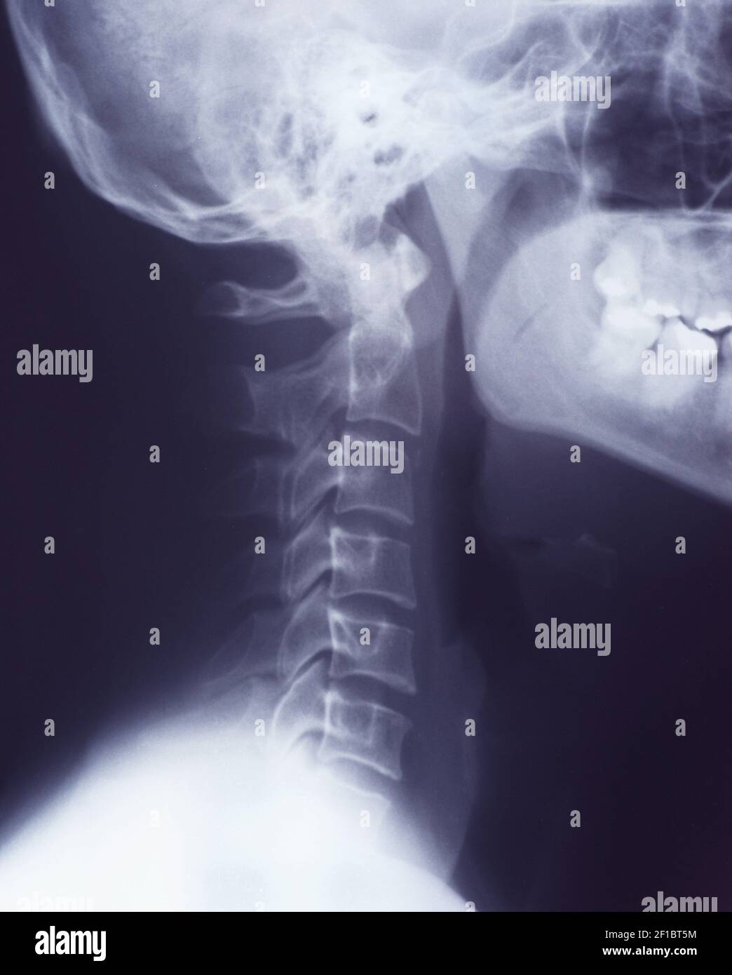 Radiographie radiographie du rachis cervical crâne os Photo Stock - Alamy