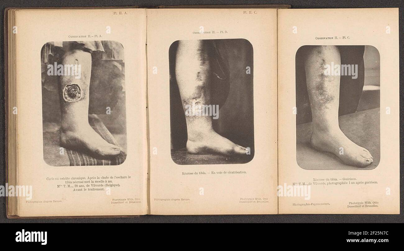 Plaie infectée que faire Banque de photographies et d’images à haute ...